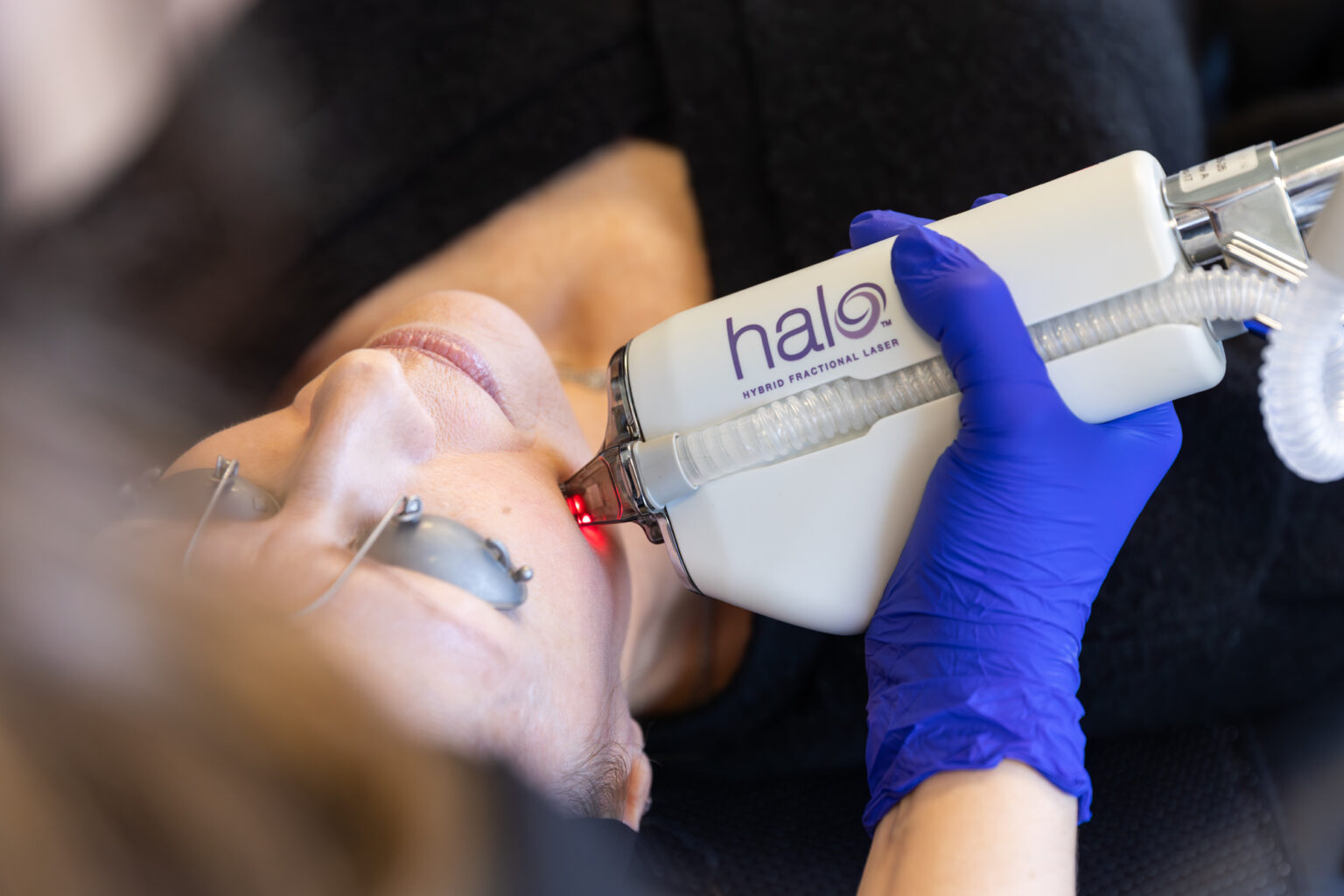 Halo Skin Laser in Denver CO - Sciton Halo Treatment