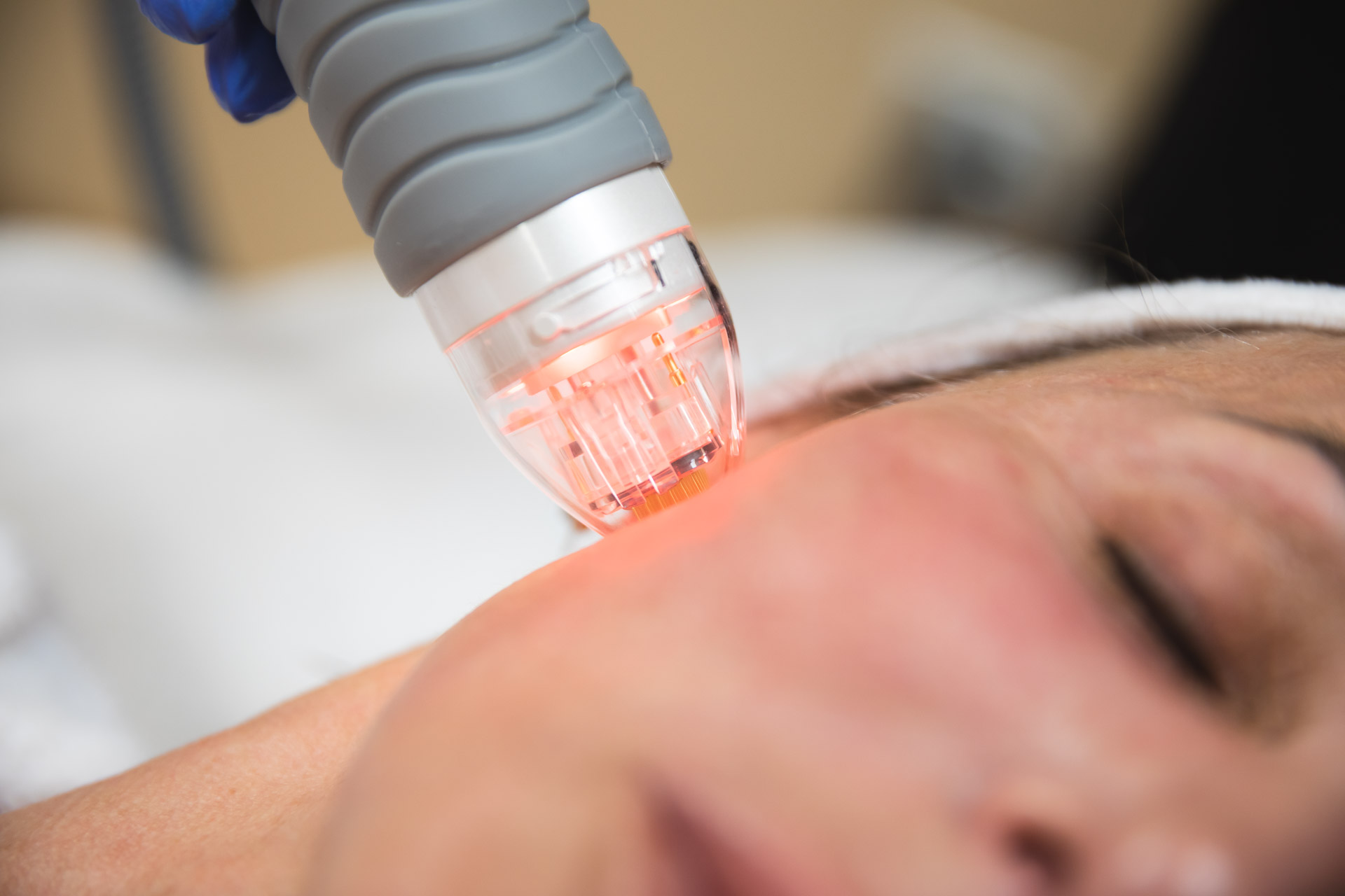 Microneedling in Parker, Colorado | Elevated Dermatology
