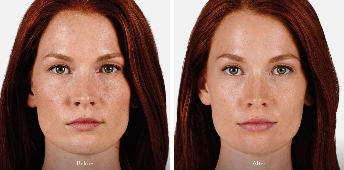 Juvederm 6 - Elevated Dermatology