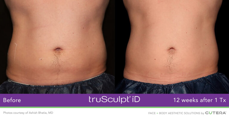 truSculpt ID 6 - Elevated Dermatology